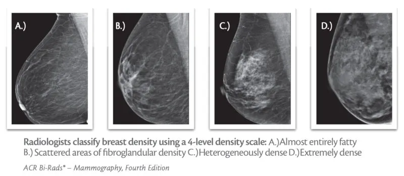 Breast Density Testing in Rochester, NY | Elizabeth Wende Breast Care